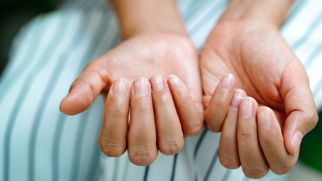 Broze nagels en vitaminetekort: wat u moet weten