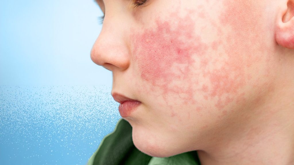 'Slapped Cheek' Parvovirus B19 verspreidt zich in de VS